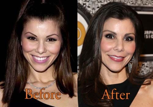 Heather Paige Kent Plastic Surgery